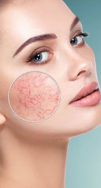 Redness - The Mayfield Clinic by Dr. Nestor